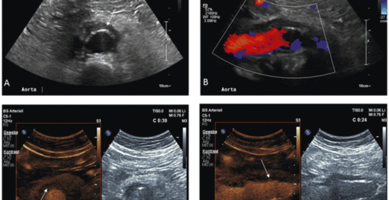 Abdominal Doppler Ultrason - Emar Tomografi