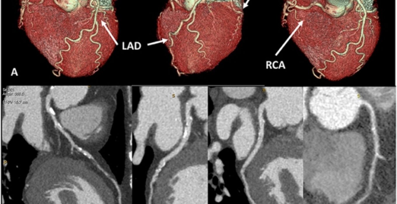 Koroner BT Anjiyografi Fiyatları 2023 - Emar Tomografi