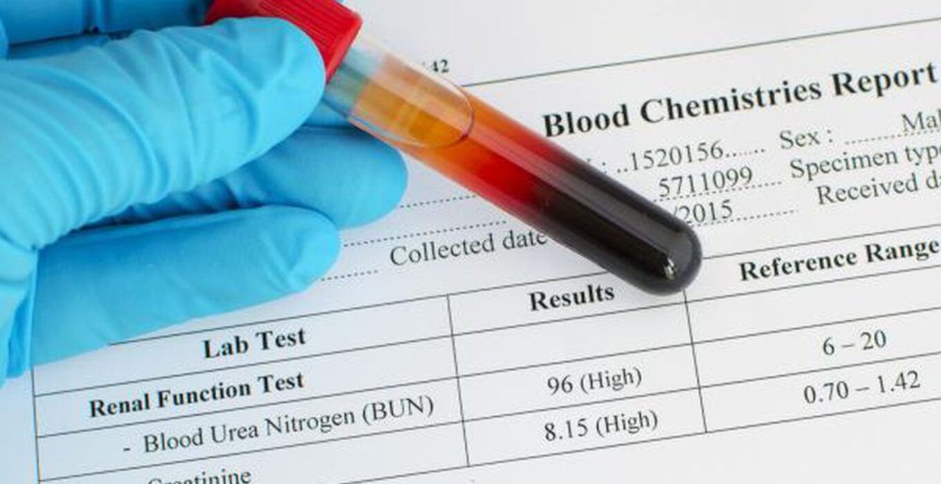 Anti-Glomerüler Bazal Membran Kan Testi: Böbrek Sağlığınızı Anlamak ...