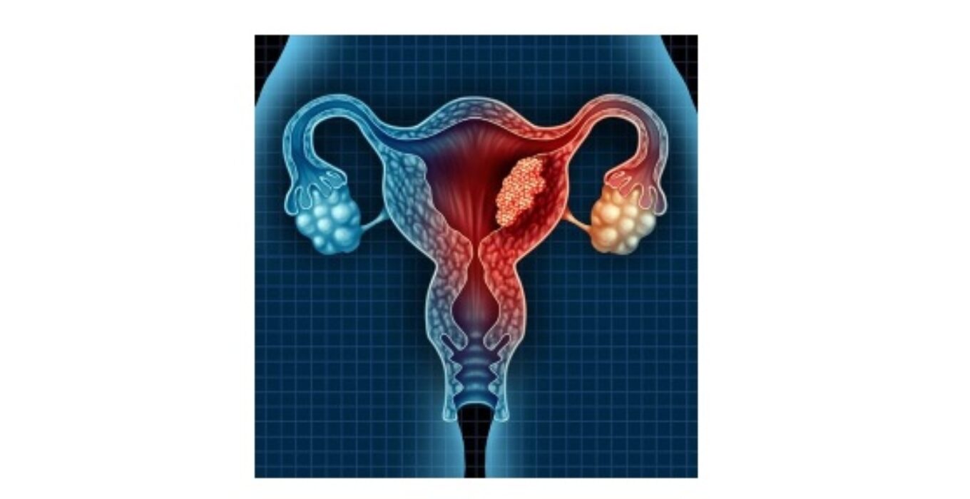 Rahim Kanseri - Emar Tomografi Görüntüleme