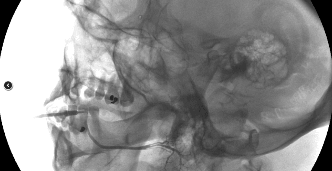 Sialogram: Tükürük Bezleri ve Tanı Yöntemi - Emar Tomografi