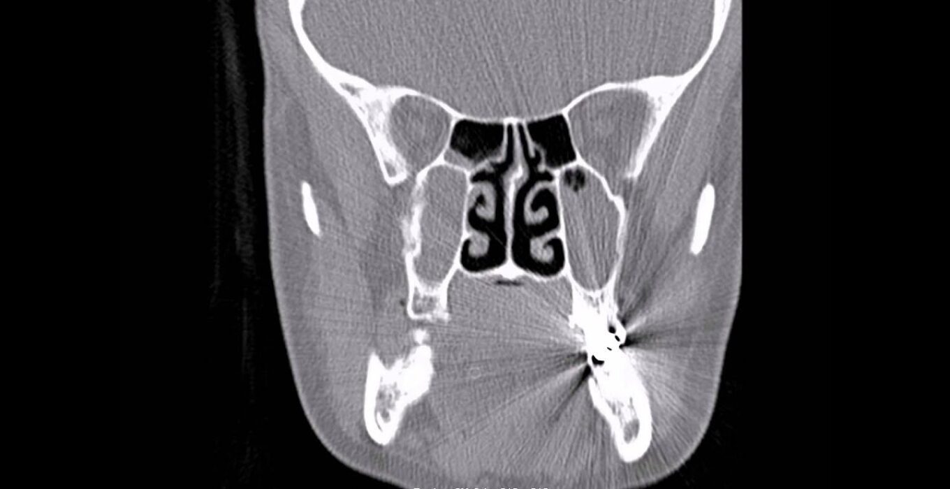Sinüs Röntgeni: Sağlığınızı Görüntülemenin İncelikleri - Emar Tomografi