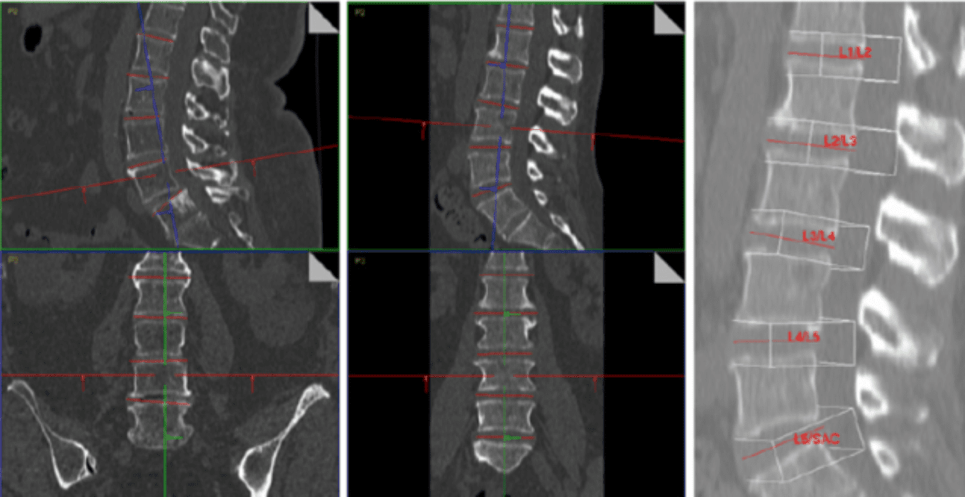 Lomber Omurga BT Taraması: Sırt Ağrılarınızın Ardındaki Sırları Açığa ...